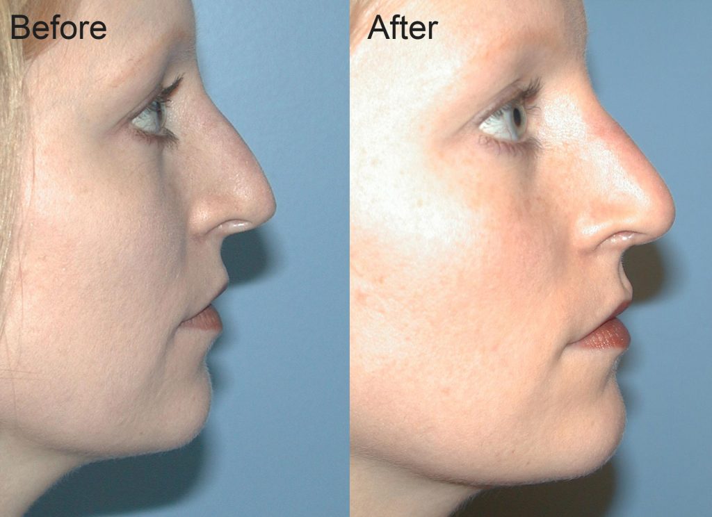 Nose Procedures in San Diego, La Jolla, Murrieta, CA | RevivaMed ...
